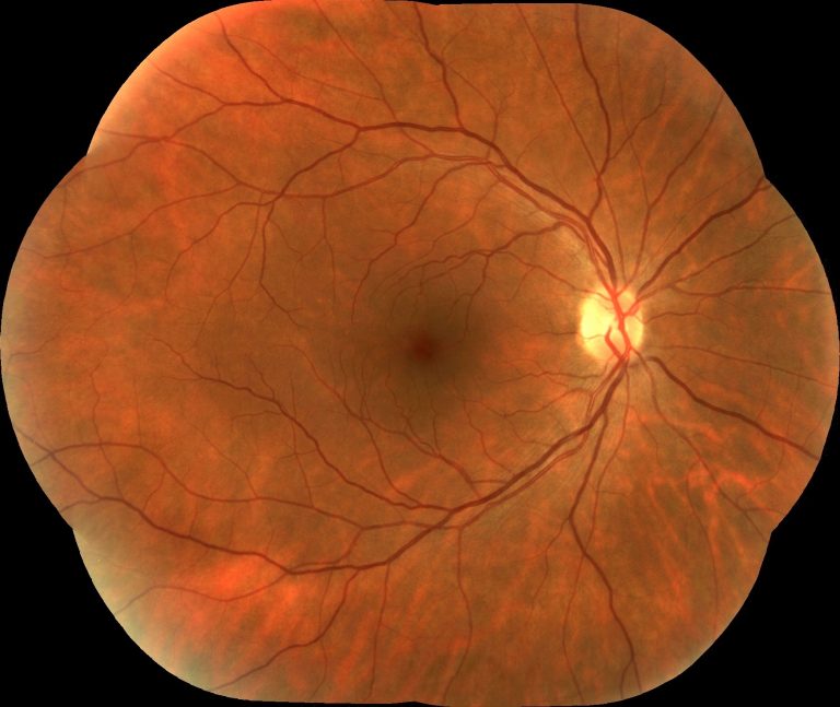 32. Retinal Arterial Macroaneurysm | OCT Club