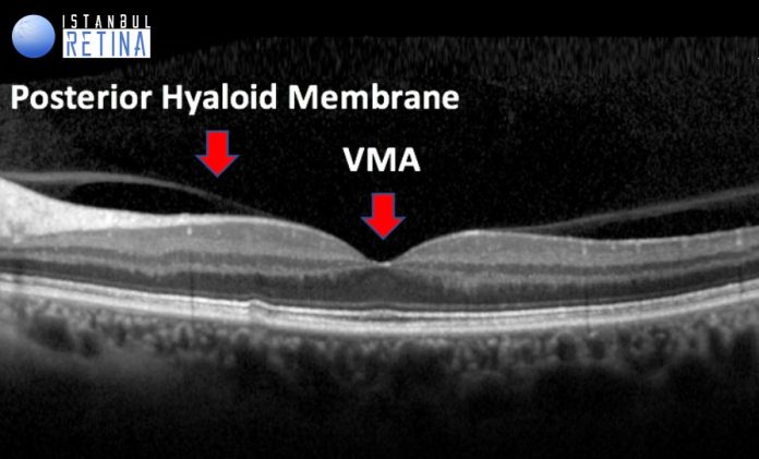 Macular Hole | OCT Club