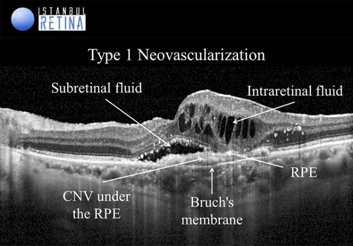 Age-related Macular Degeneration | OCT Club