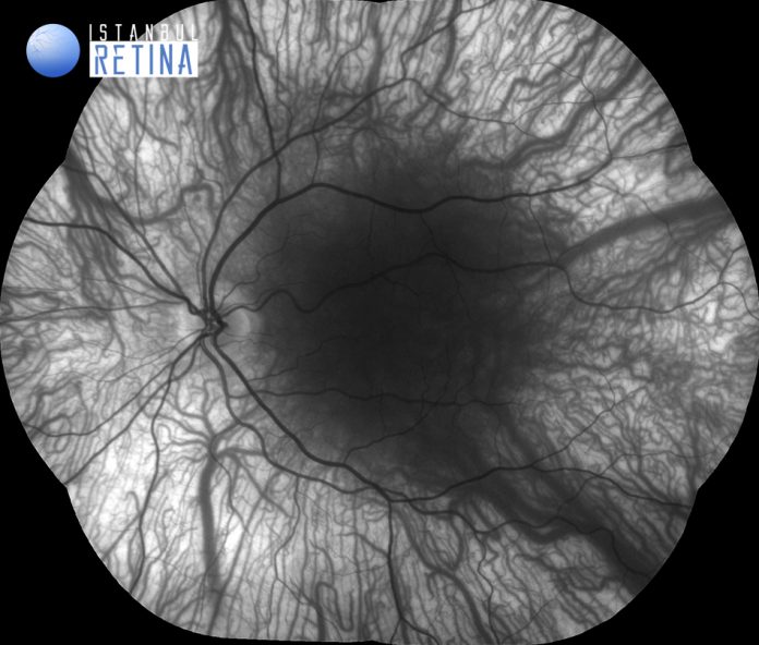 37. Ocular Albinism | OCT Club