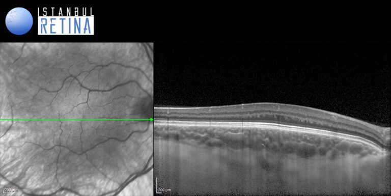 37. Ocular Albinism | OCT Club