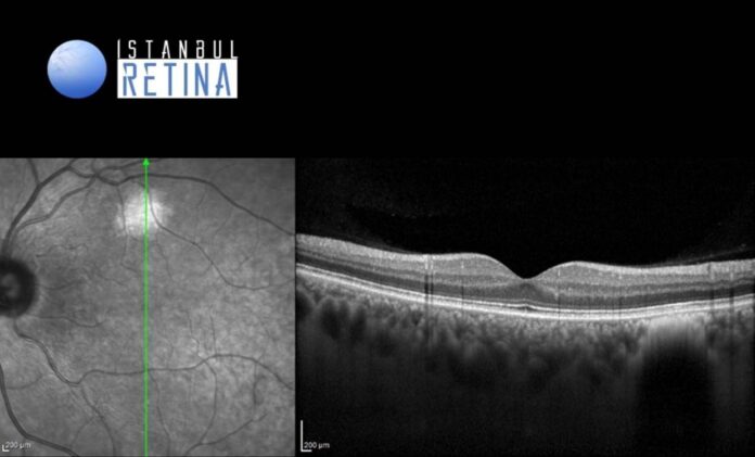 55. Choroidal Nevus | OCT Club