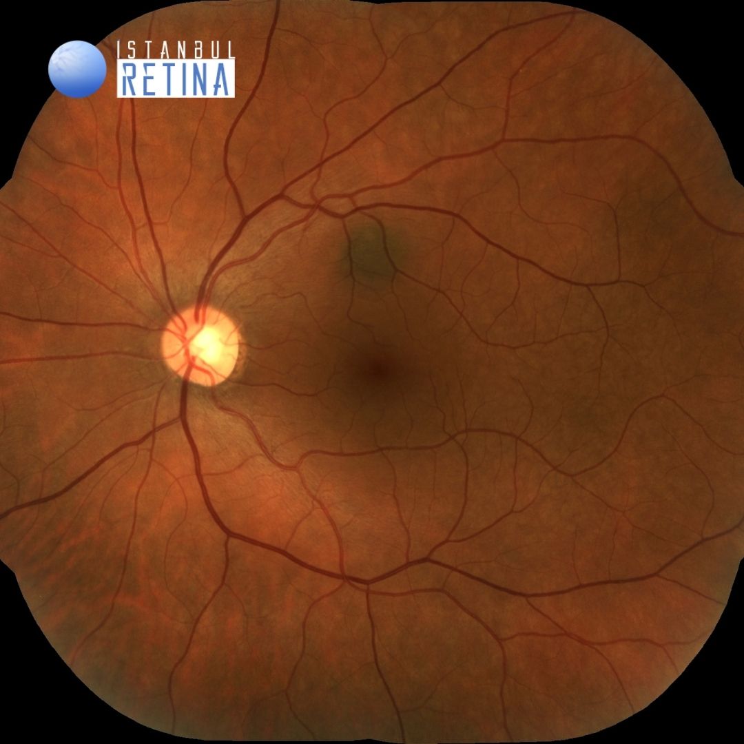 55. Choroidal Nevus | OCT Club