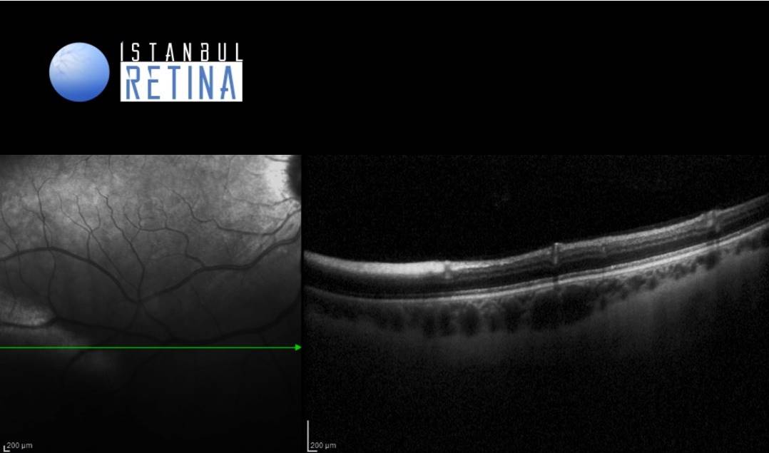 56 Myelinated Retinal Nerve Fiber Layer Oct Club
