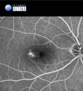 65. Perifoveal Exudative Vascular Anomalous Complex (PEVAC) | OCT Club