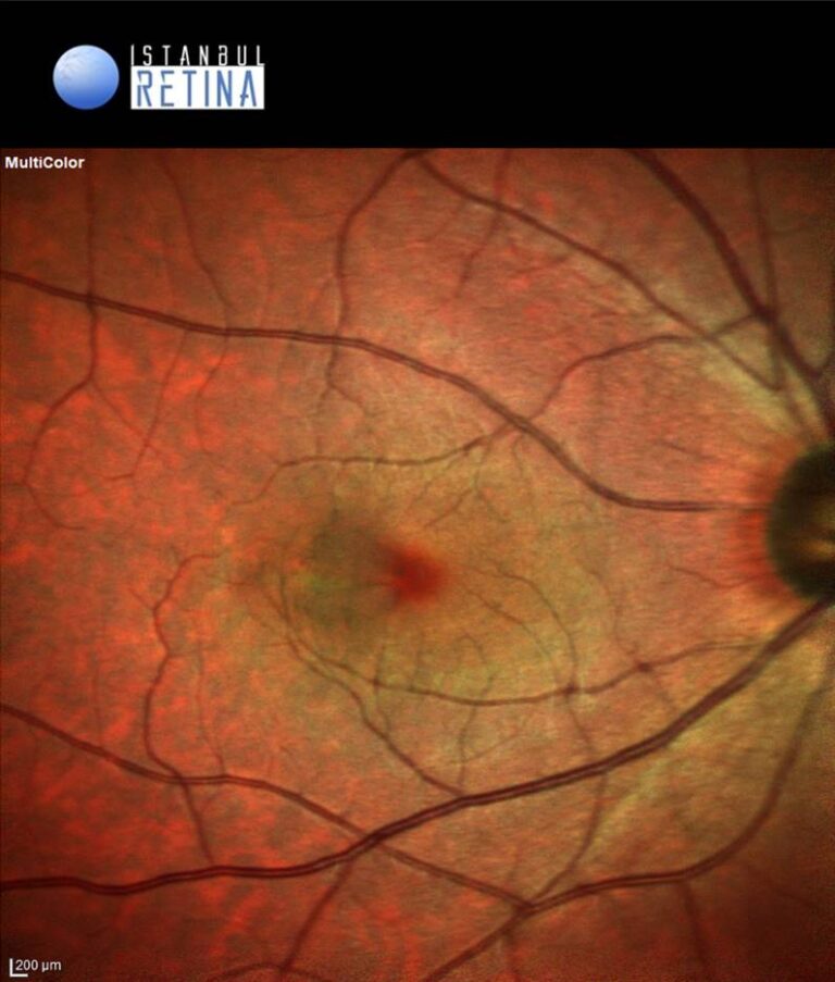 65. Perifoveal Exudative Vascular Anomalous Complex (PEVAC) | OCT Club