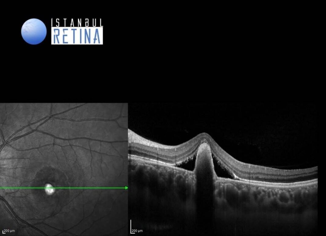 66. Best Disease Presenting as Subretinal Pigment Epithelium ...
