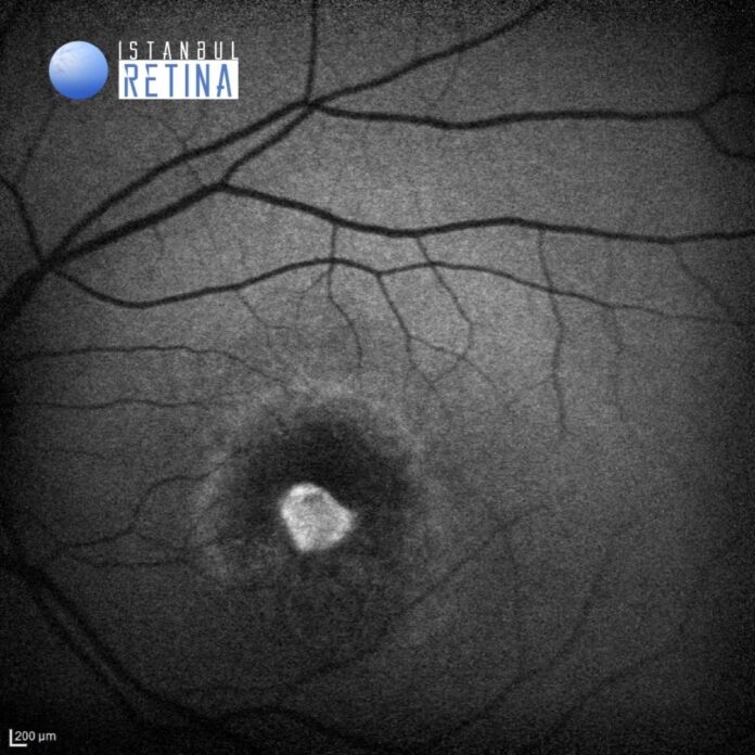 66. Best Disease Presenting as Subretinal Pigment Epithelium ...